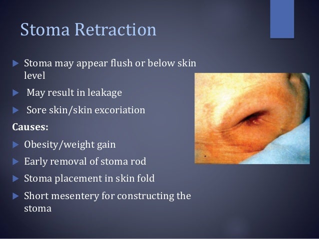 Stoma Common Problems