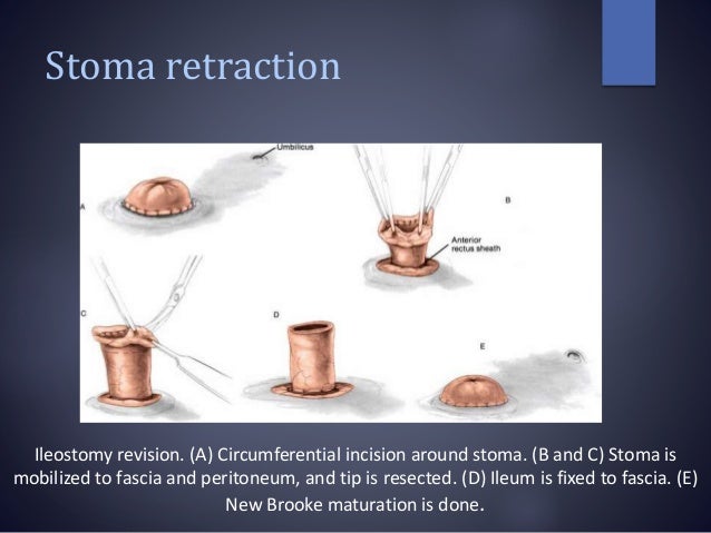 Stoma complications & its management