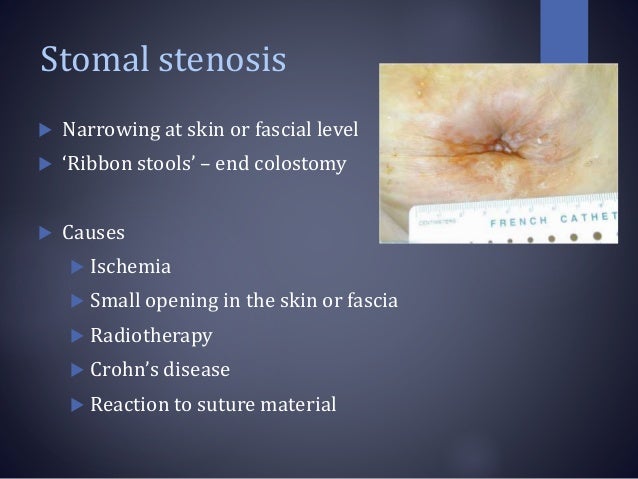 Stoma complications & its management