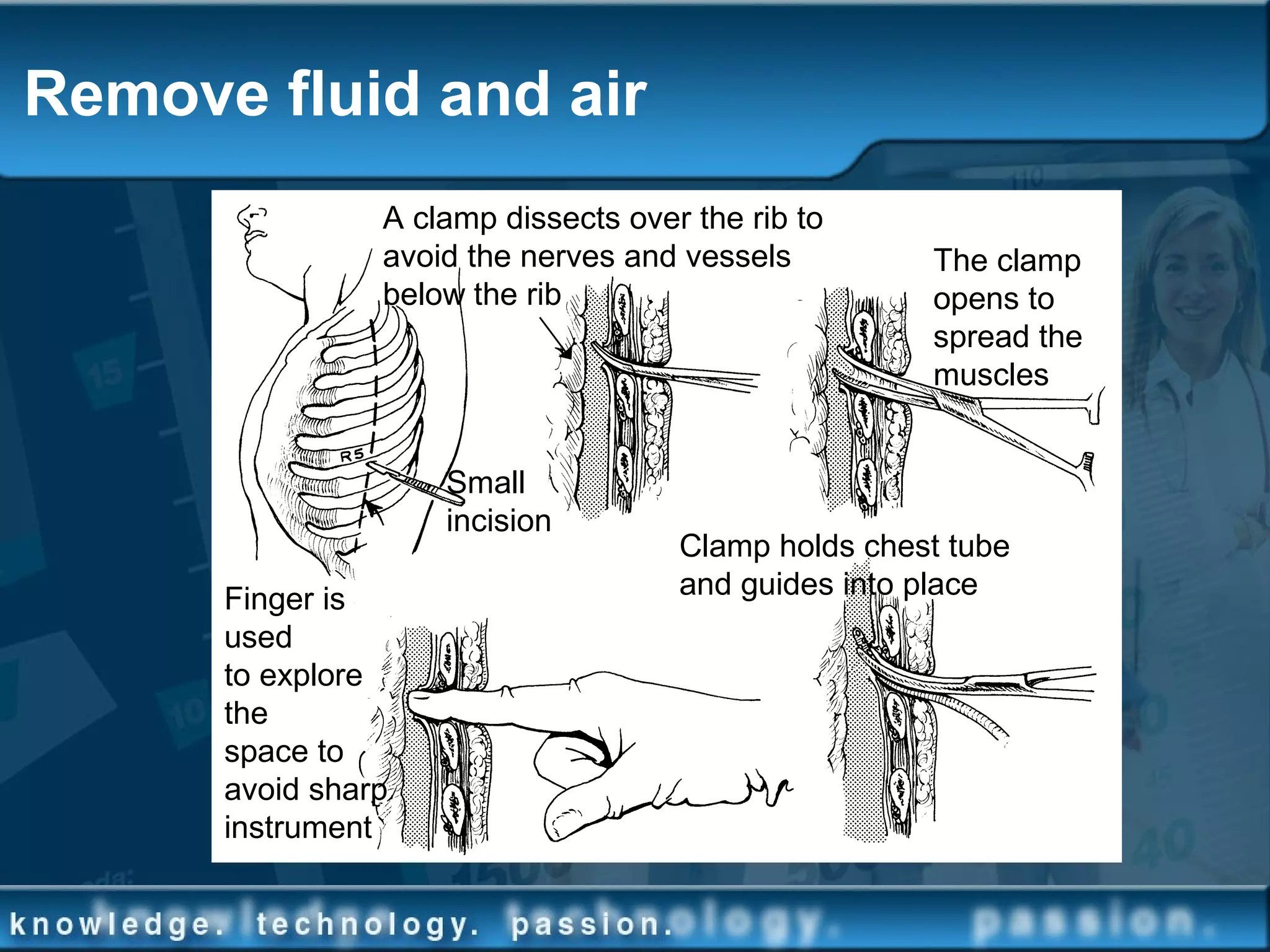 Managing chestdrainage | PPT