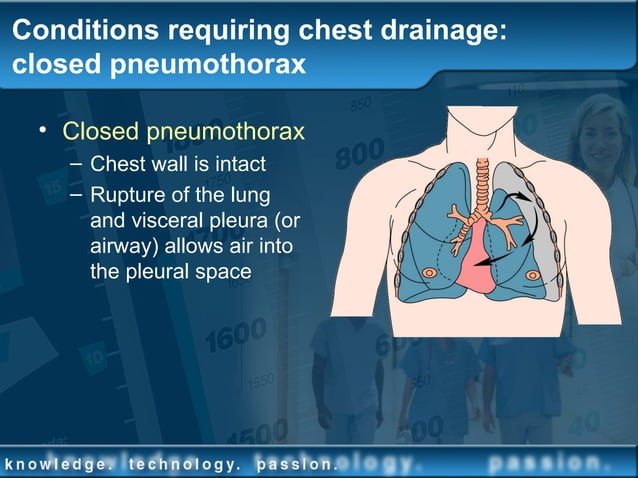 Managing chestdrainage | PPT