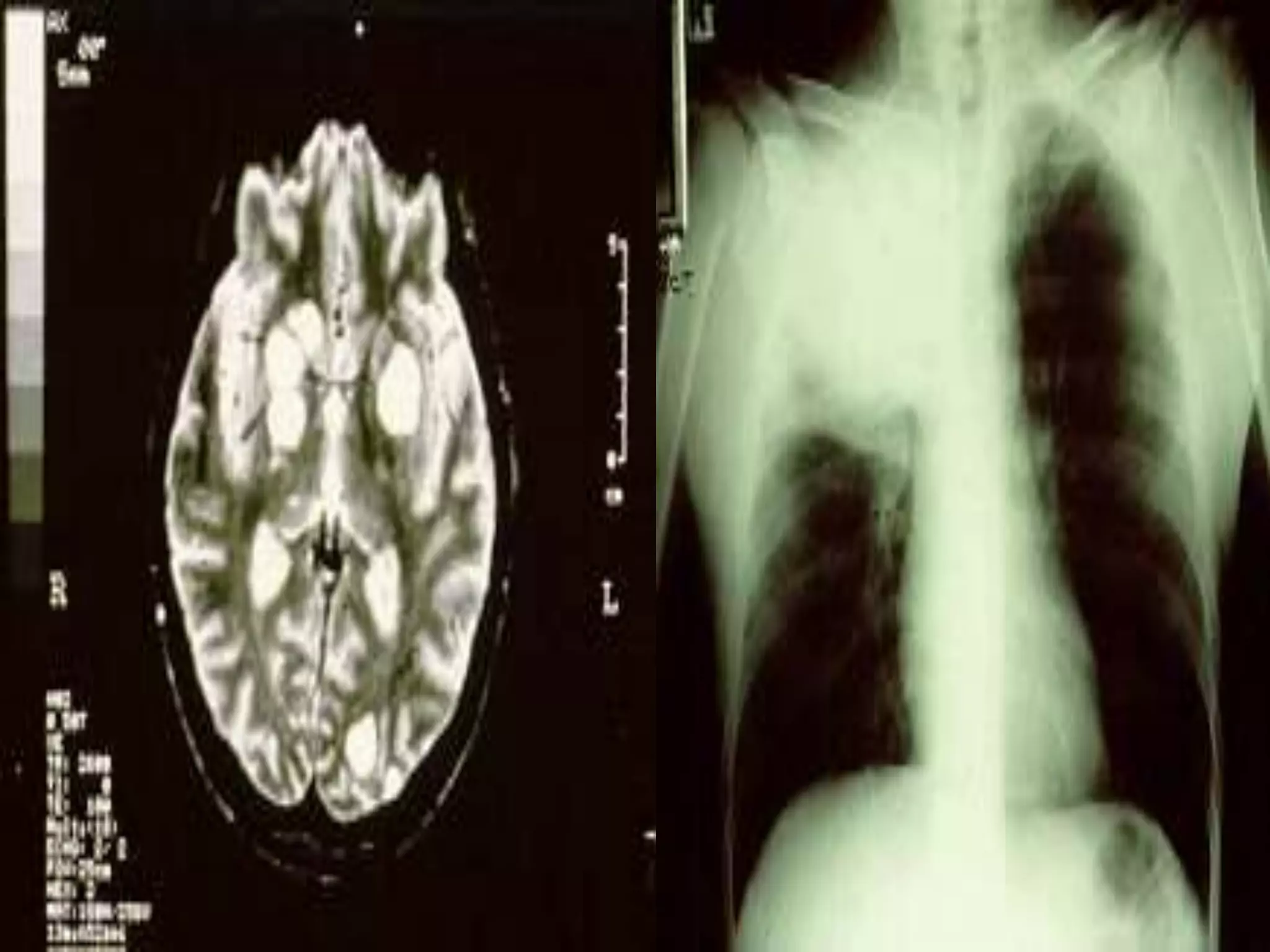 Yeasts of medical importance - Candida and Cryptococcus | PPT