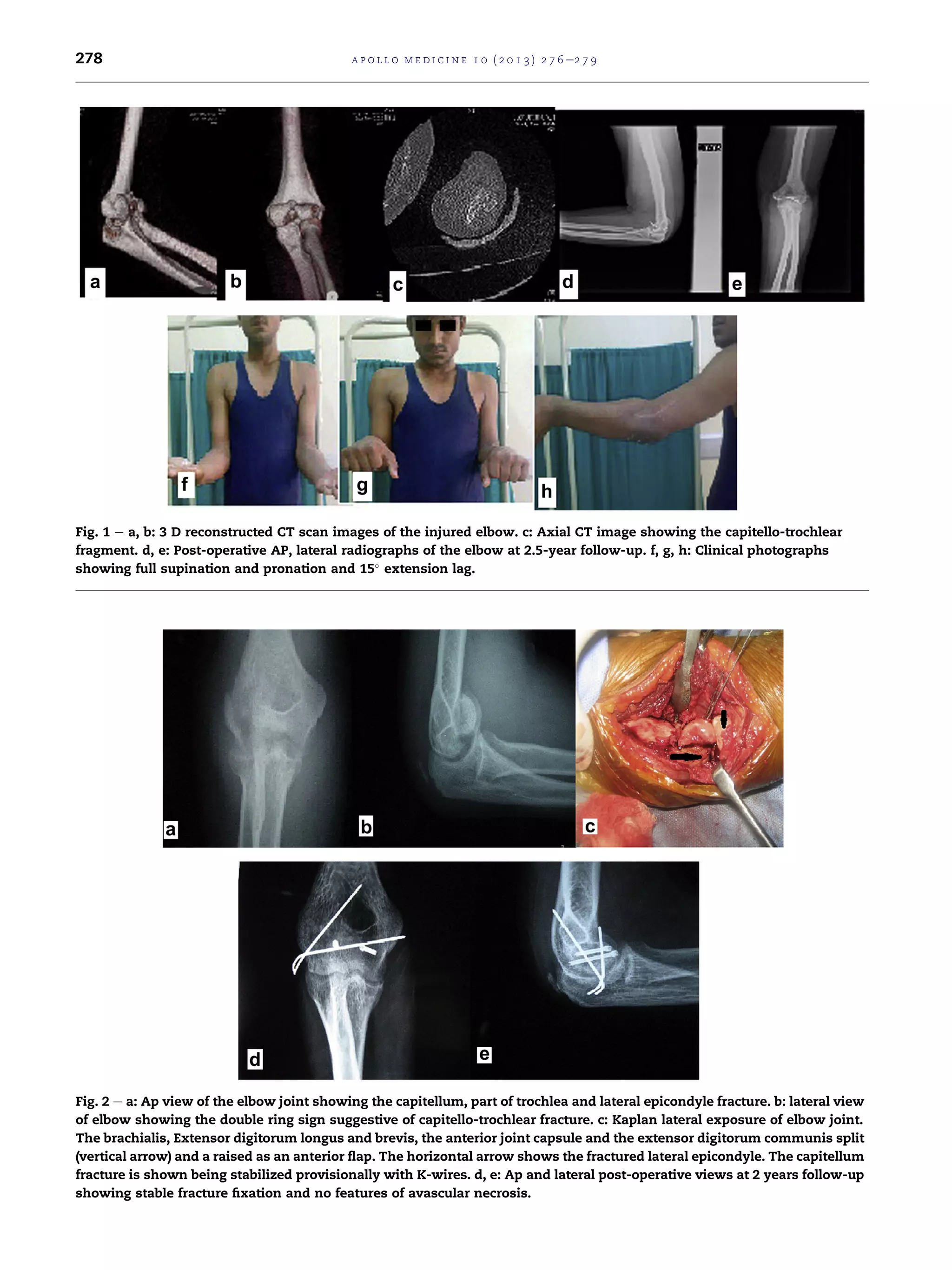 Internal fixation of fractures of the capitellum and trochlea ...