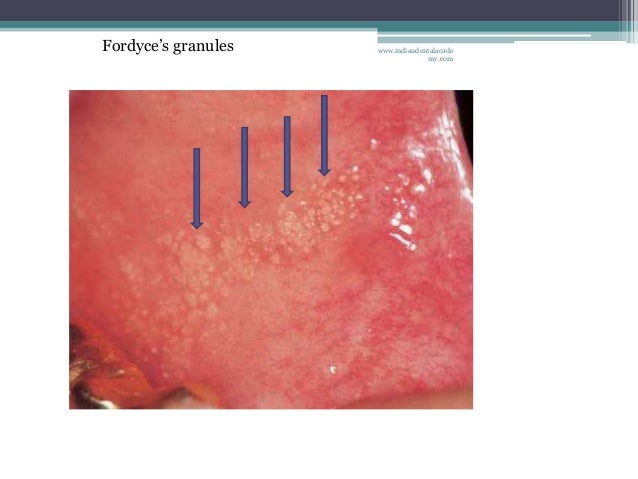 Yellowish conditions of oral cavity