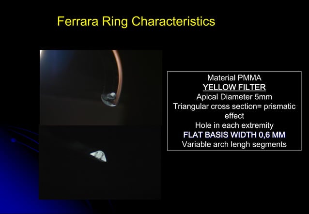 Keratoconus. Yellow Rings | PPT
