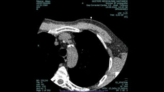 16th Experts Live CTO: Live Case CT Analysis | PPT