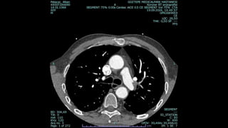16th Experts Live CTO: Live Case CT Analysis | PPT