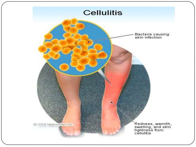Cellulitis Causes