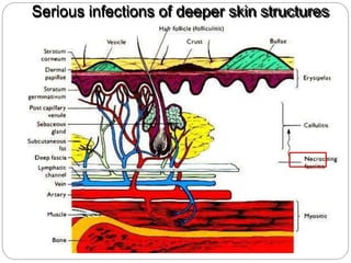 cellulitis | PPTX | Skin and Dermatology | Diseases and Conditions