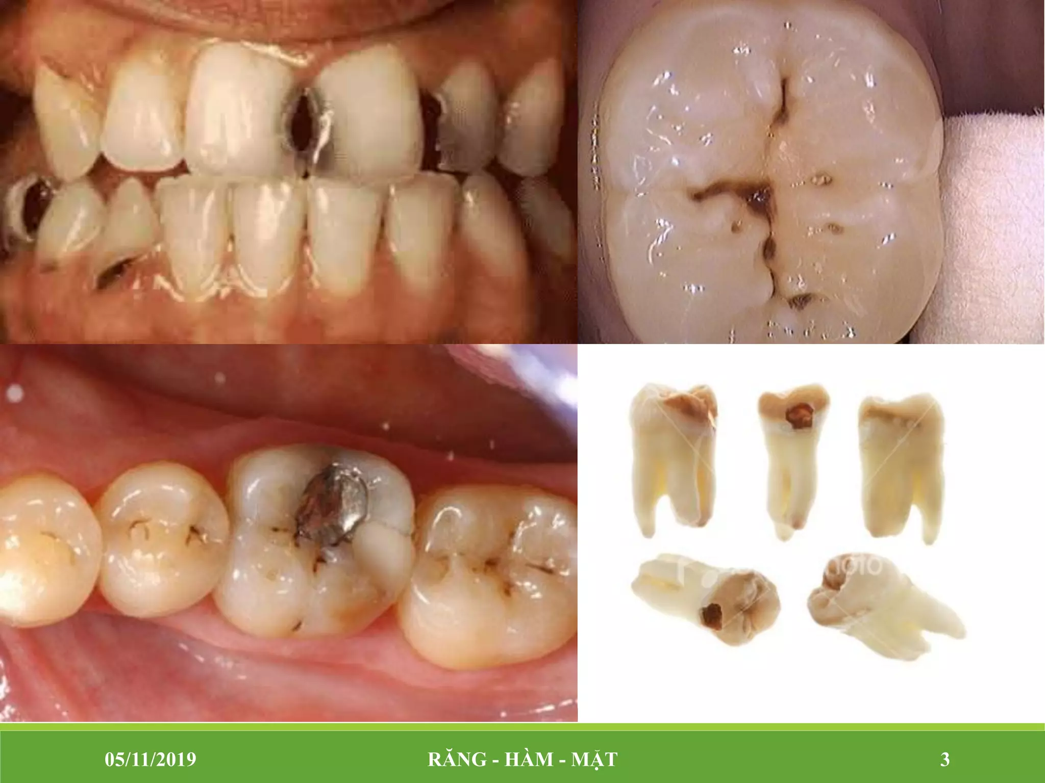 Benh hoc rang ham mat | PDF