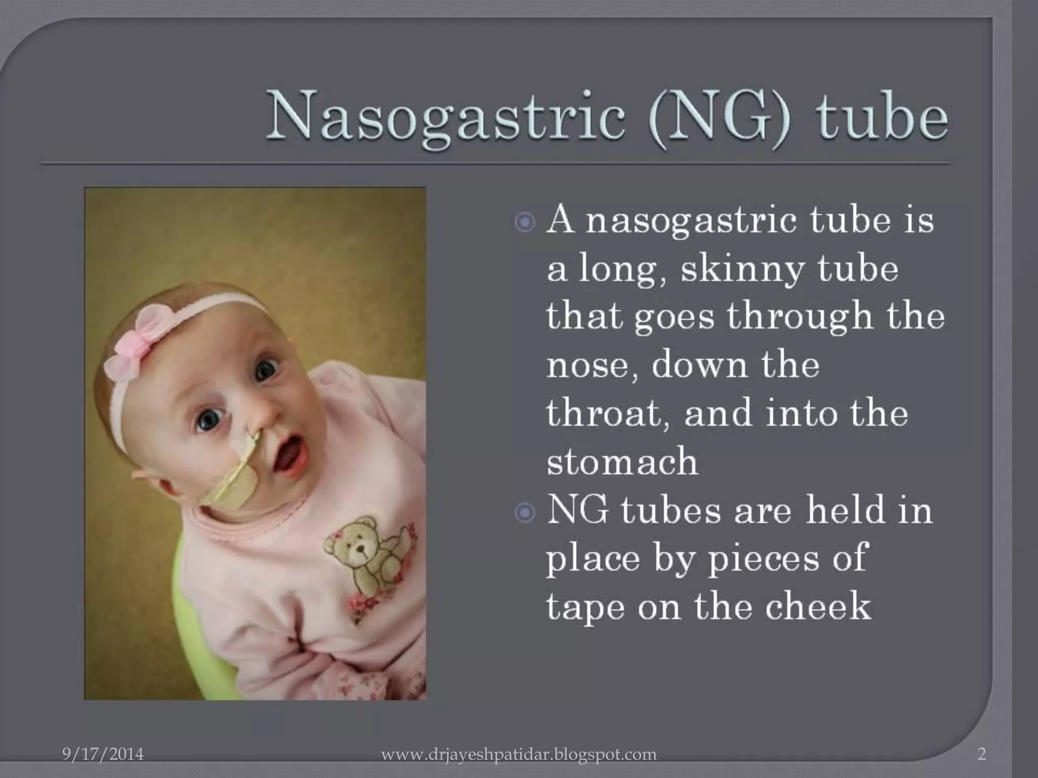 Nasogastric feeding or gavage feeding | PDF