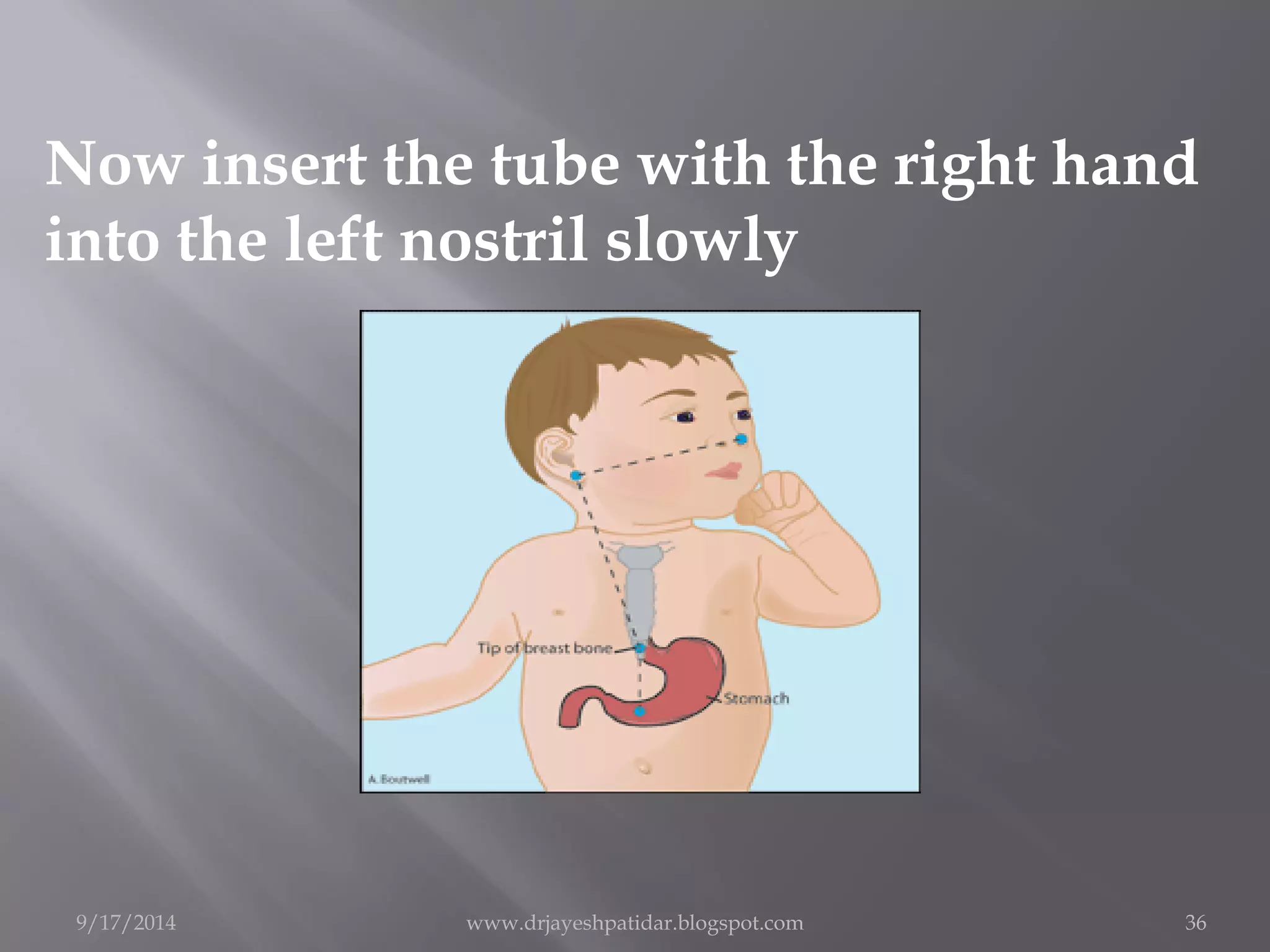 Nasogastric feeding or gavage feeding | PDF