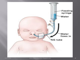 Nasogastric feeding or gavage feeding PPT