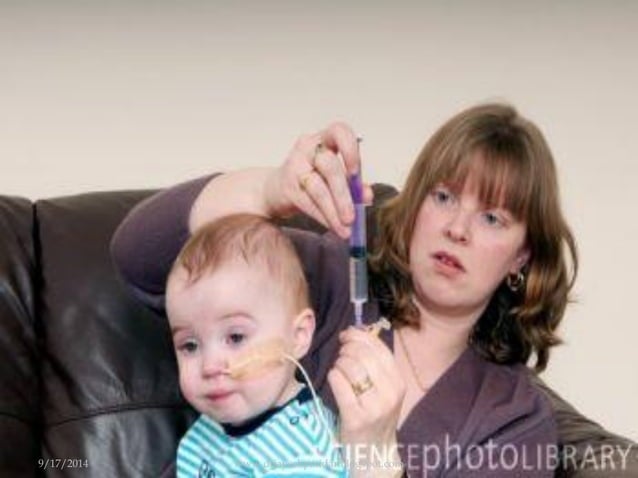 Nasogastric feeding or gavage feeding | PDF