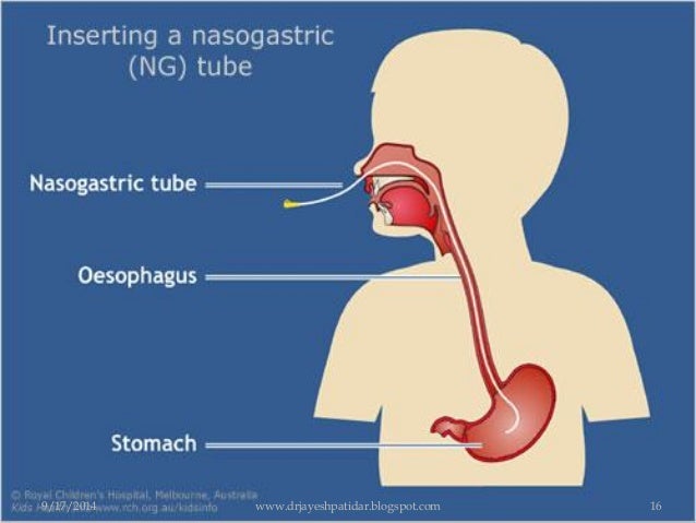 Nasogastric feeding or gavage feeding
