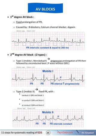 [YhocData.com] Bản Dịch 11 Bước Đọc ECG | PDF
