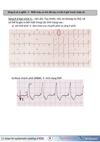 [YhocData.com] Bản Dịch 11 Bước Đọc ECG | PDF