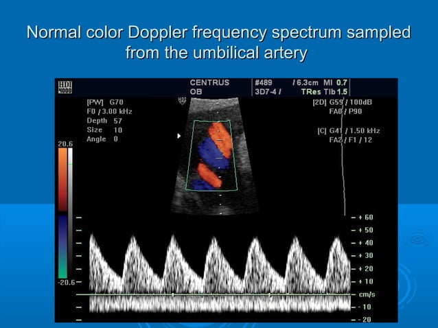 Antenatal doppler | PPSX
