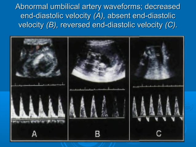 Antenatal doppler | PPSX