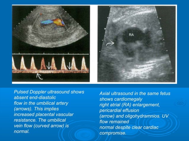 Antenatal doppler | PPSX