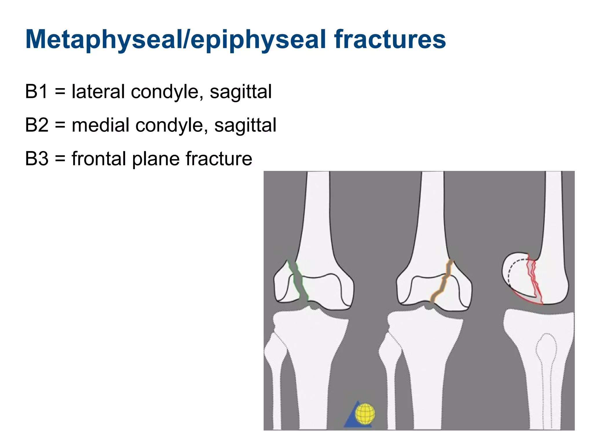 AO Classification | PPT