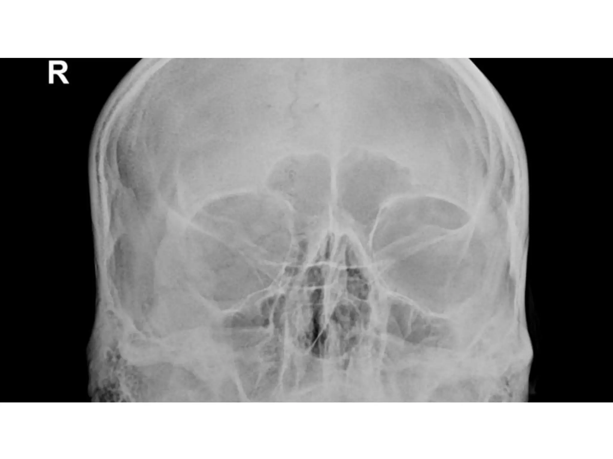 xray_Paranasal sinus and orbit-_.pptx