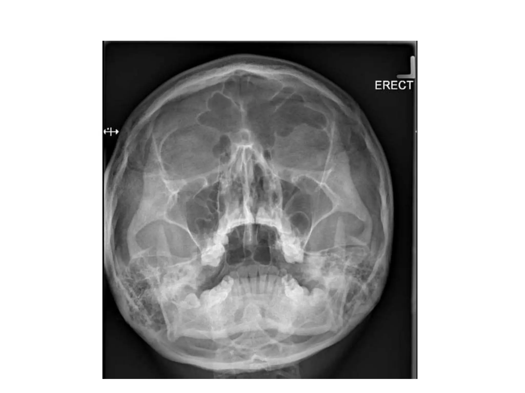 xray_Paranasal sinus and orbit-_.pptx