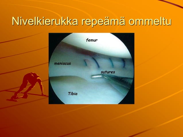 Tyypilliset urheilijan nilkka- ja polvivammat ja niiden ennaltaehkäisy ...
