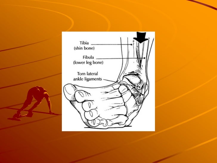 Tyypilliset urheilijan nilkka- ja polvivammat ja niiden ennaltaehkäisy