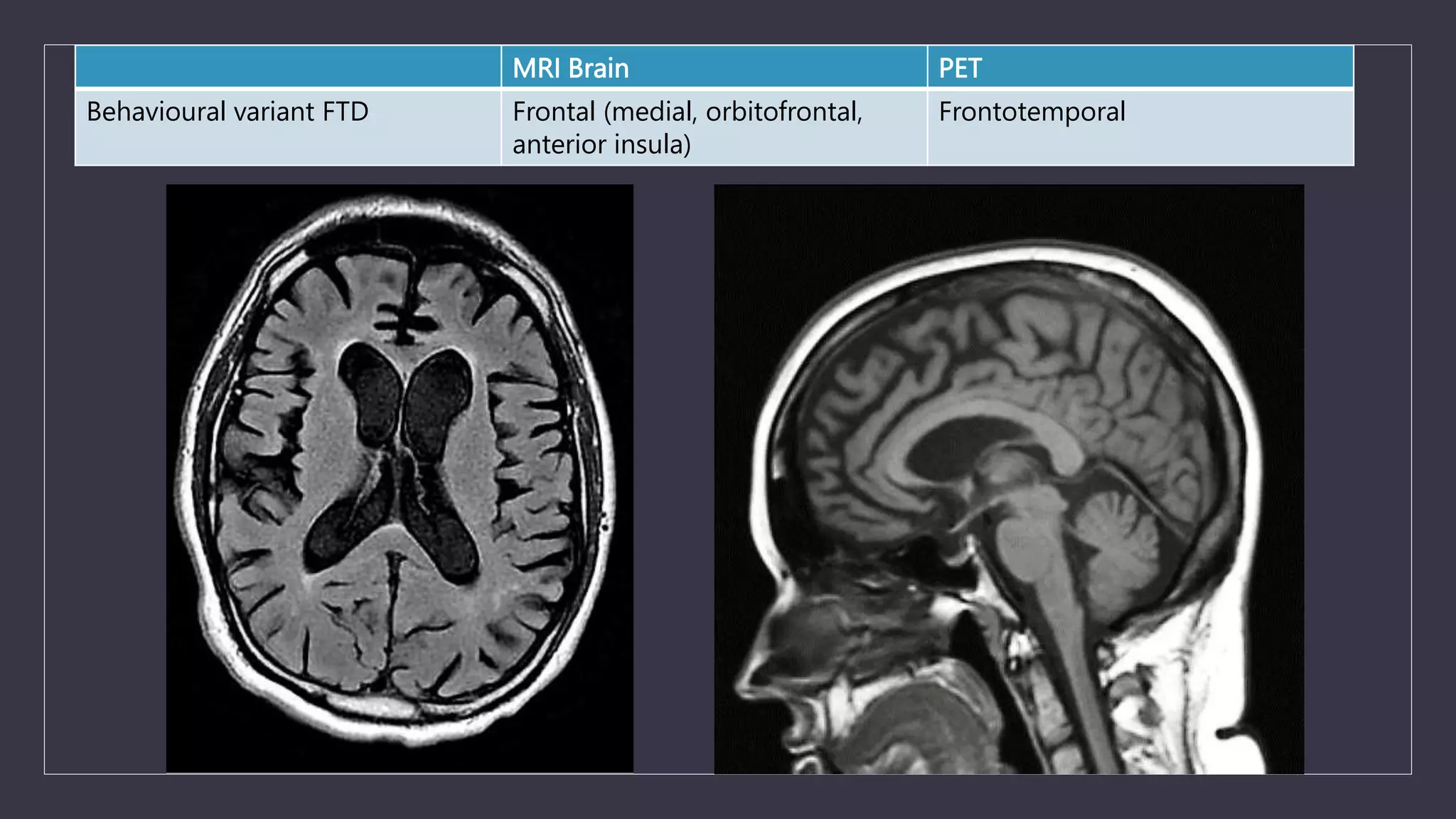 Young Onset Dementia.pptx
