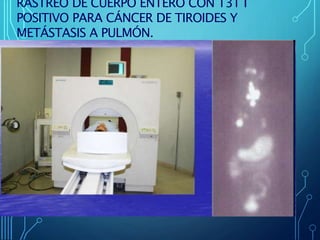 YODO RADIOACTIVO.pptx