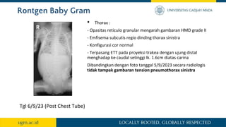 Yohan Parulian Sinaga Pneumothorax.pptx