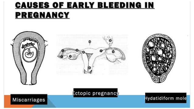 miscarriage diagnosis and its management.pdf
