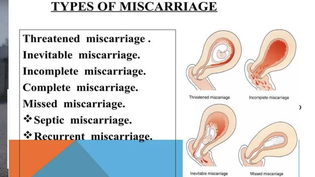 miscarriage diagnosis and its management.pdf
