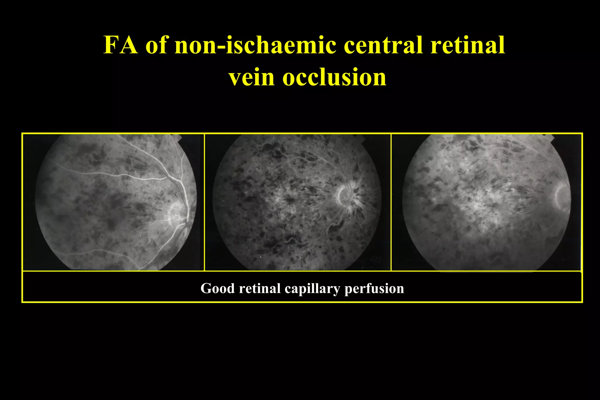Retinal Vascular occlusion | PPT