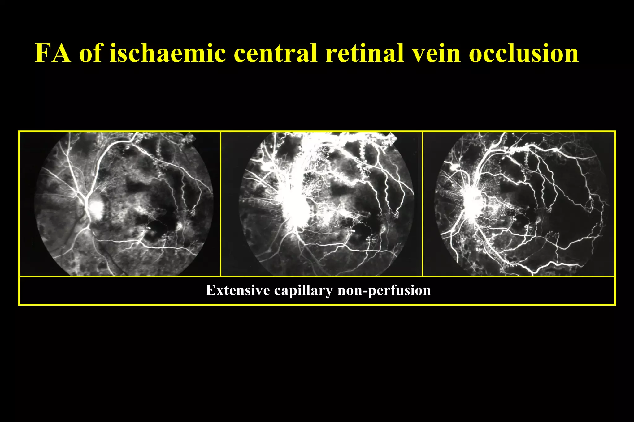 Retinal Vascular occlusion | PPT