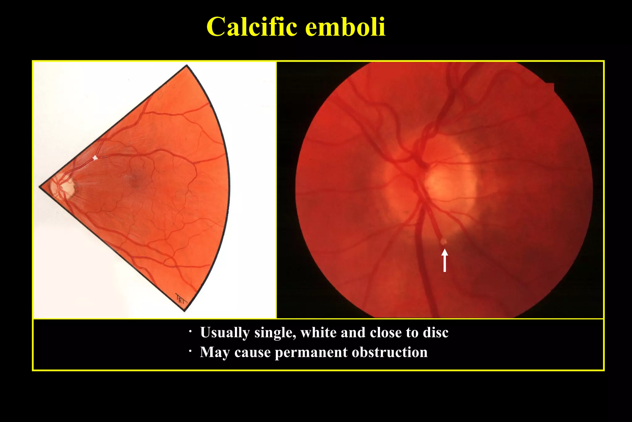 Retinal Vascular occlusion | PPT