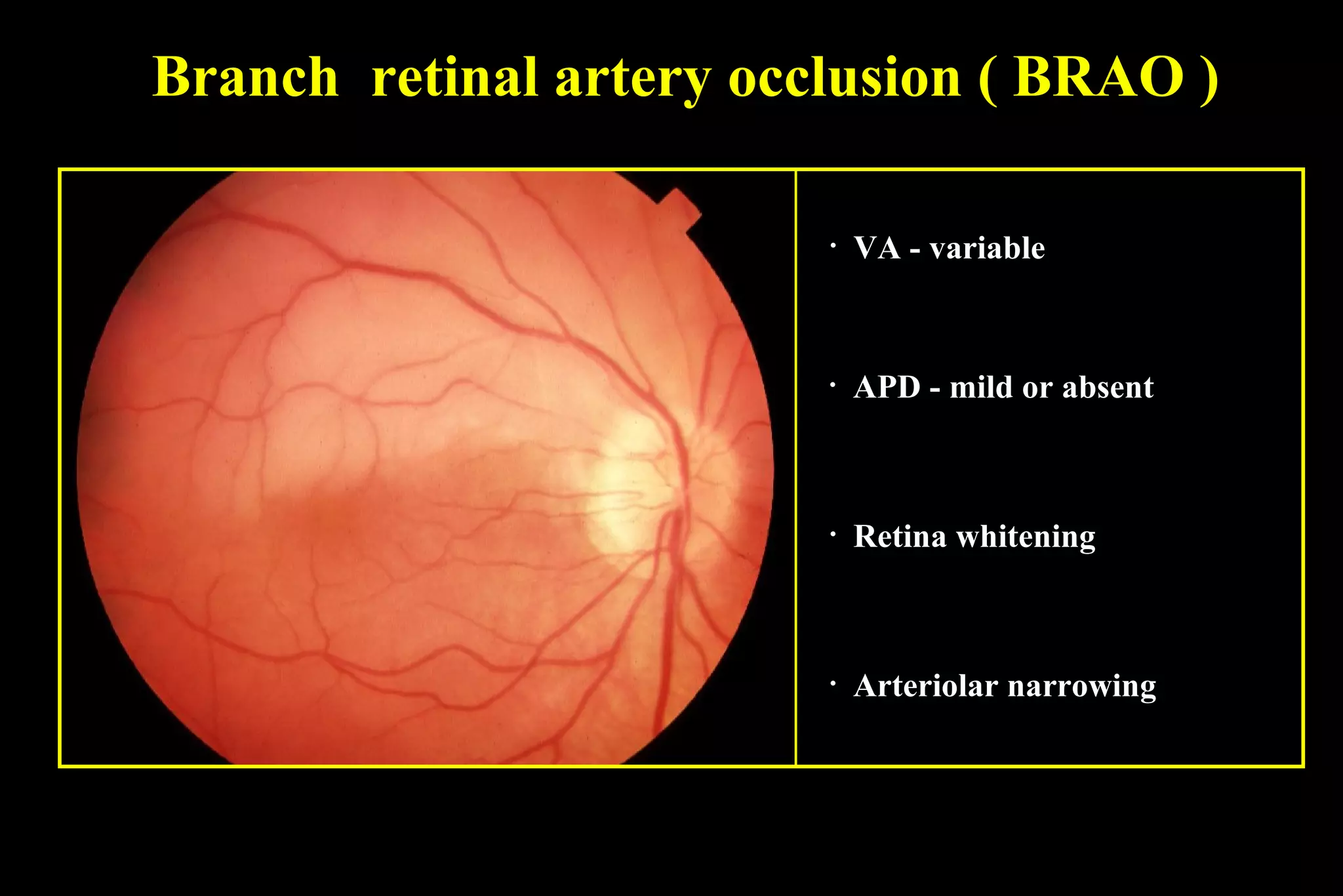 Retinal Vascular occlusion | PPT