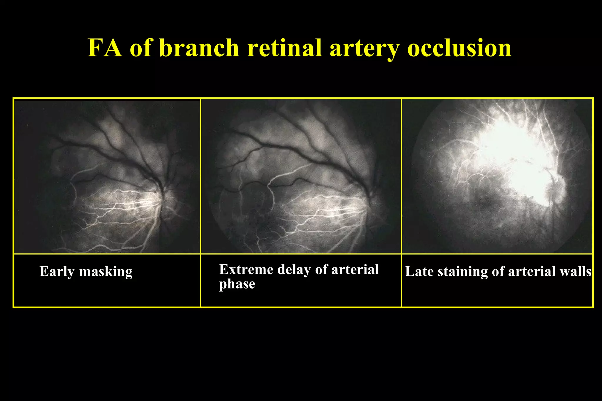 Retinal Vascular occlusion | PPT
