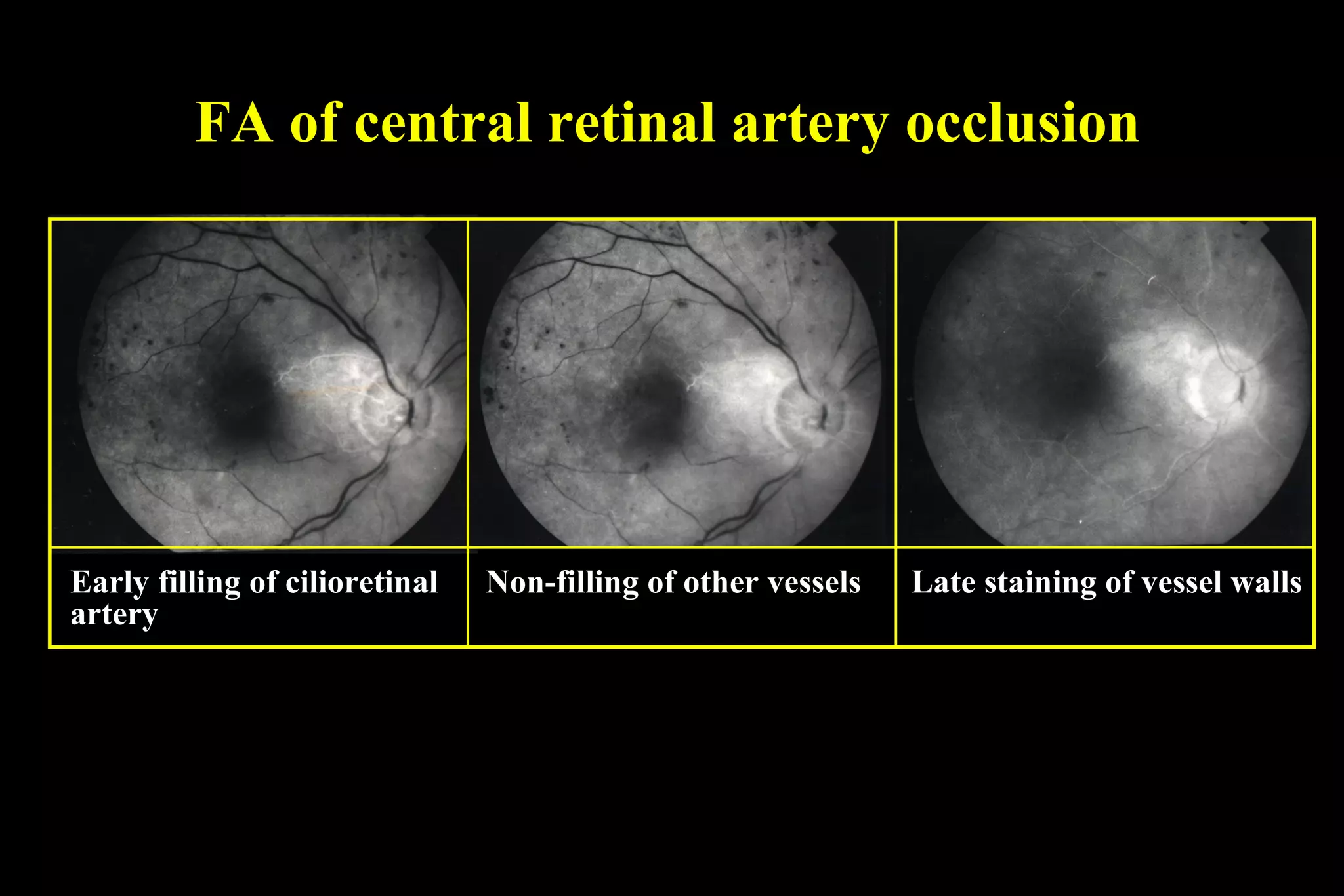 Retinal Vascular occlusion | PPT