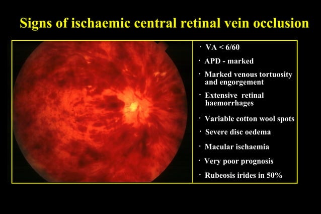 Retinal Vascular occlusion | PPT