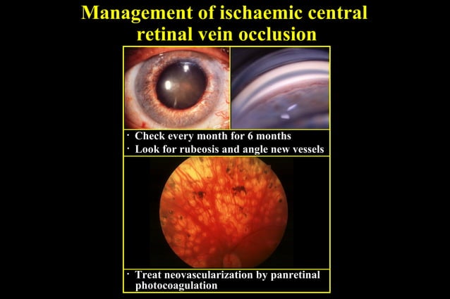 Retinal Vascular occlusion | PPT | Eye and Vision Conditions | Diseases ...