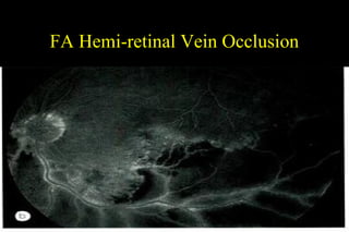 Retinal Vascular occlusion | PPT