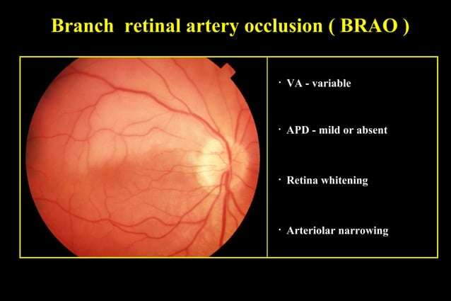 Retinal Vascular occlusion | PPT | Eye and Vision Conditions | Diseases ...