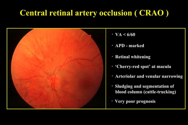 Retinal Vascular occlusion | PPT | Eye and Vision Conditions | Diseases ...