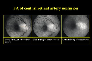 Retinal Vascular occlusion | PPT