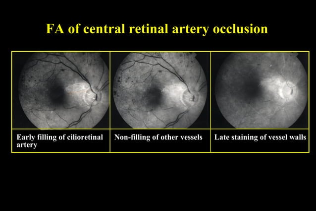 Retinal Vascular occlusion | PPT | Eye and Vision Conditions | Diseases ...