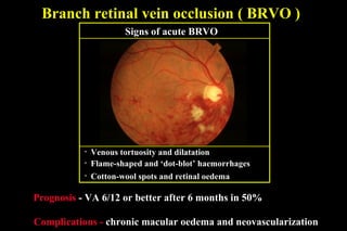 Retinal Vascular occlusion | PPT