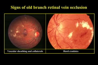 Retinal Vascular Sheathing