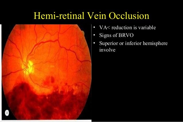 Retinal Vascular occlusion